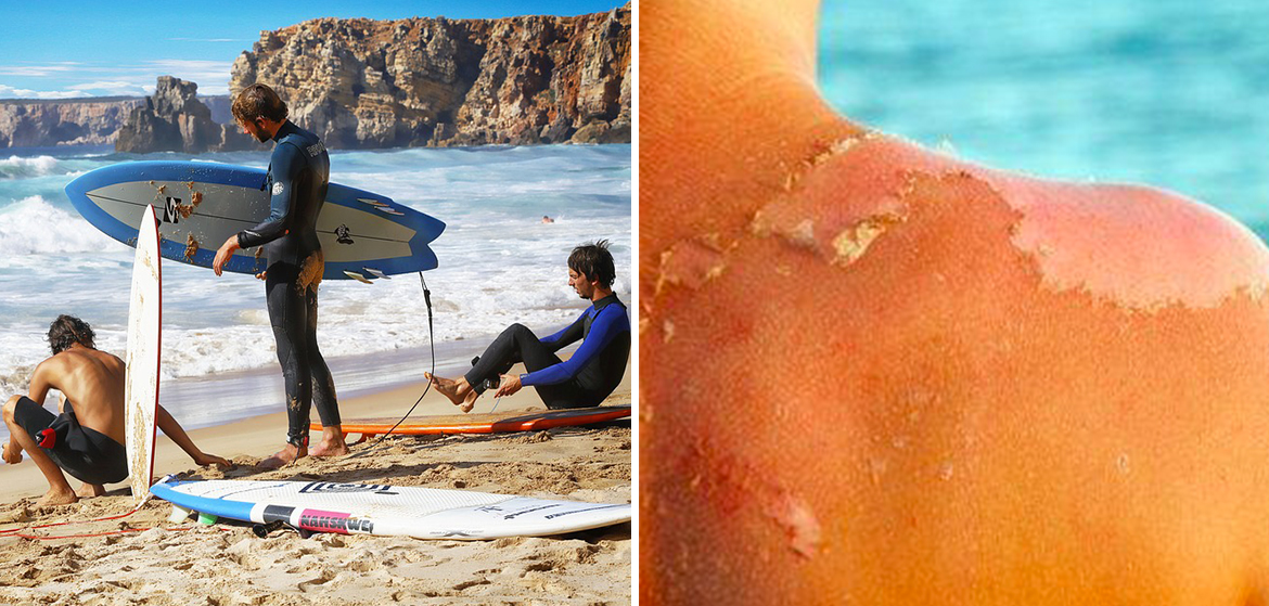 "Le surf est mauvais pour la santé" épisode 5 : Les maladies de peau